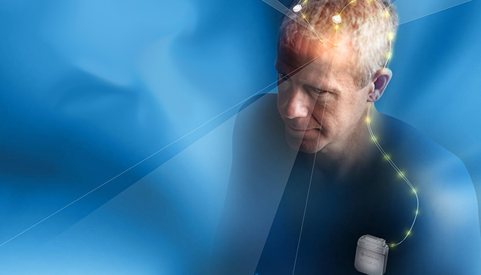 Deep brain stimulation: merging brains and machines - Queensland Brain ... Deep brain stimulation: merging brains and machines - Queensland Brain ...